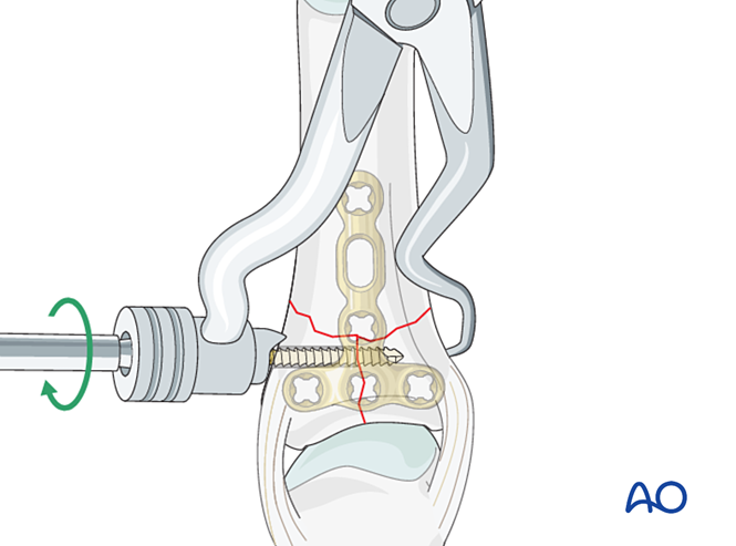 Plating with a dorsal T-plate for Complete articular fracture of the ...