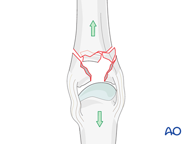 Plating with a dorsal T-plate for Complete articular fracture of the ...