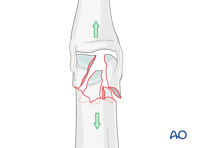 Plating with a lateral plate for Complete articular fracture of the ...