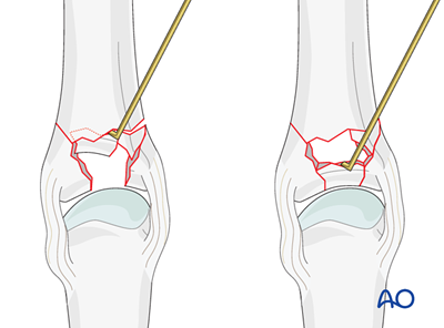 Plating with a dorsal T-plate for Complete articular fracture of the ...