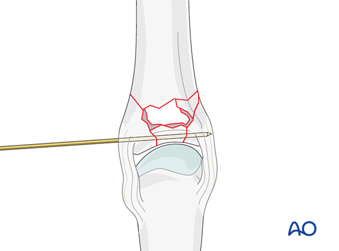 Plating with a dorsal T-plate for Complete articular fracture of the ...