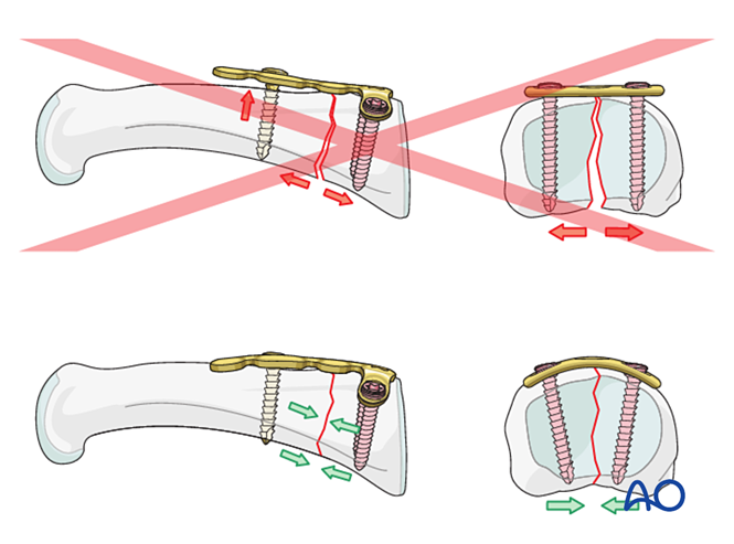 Plating with a dorsal T-plate for Complete articular fracture of the ...