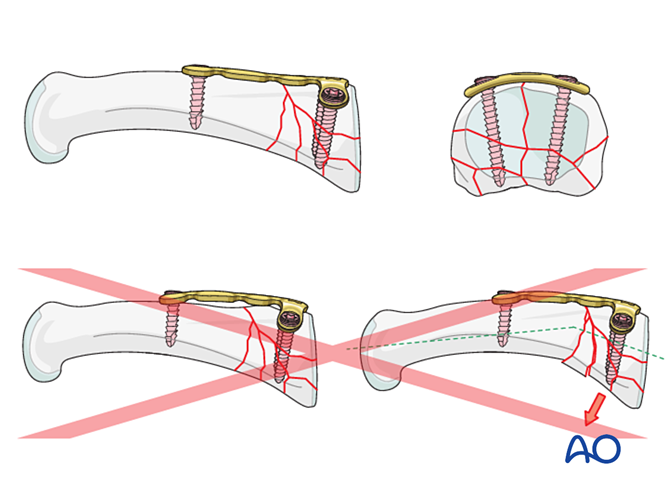Plating with a dorsal T-plate for Complete articular fracture of the ...