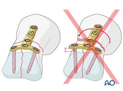 Plating with a dorsal T-plate for Complete articular fracture of the ...