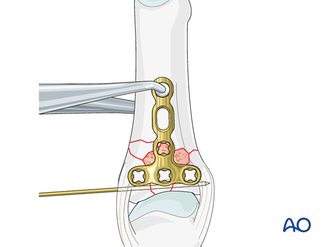 Plating with a dorsal T-plate for Complete articular fracture of the ...