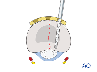 Plating with a dorsal T-plate for Complete articular fracture of the ...