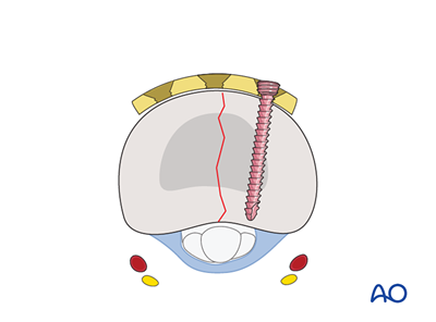 Plating with a dorsal T-plate for Complete articular fracture of the ...