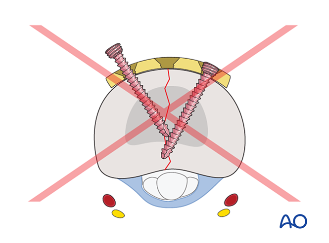 Plating with a dorsal T-plate for Complete articular fracture of the ...
