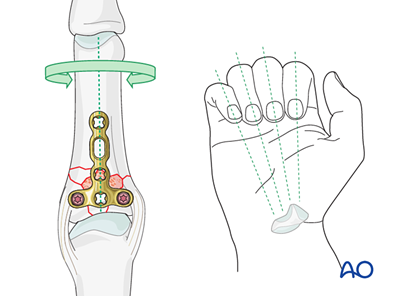 Plating with a dorsal T-plate for Complete articular fracture of the ...