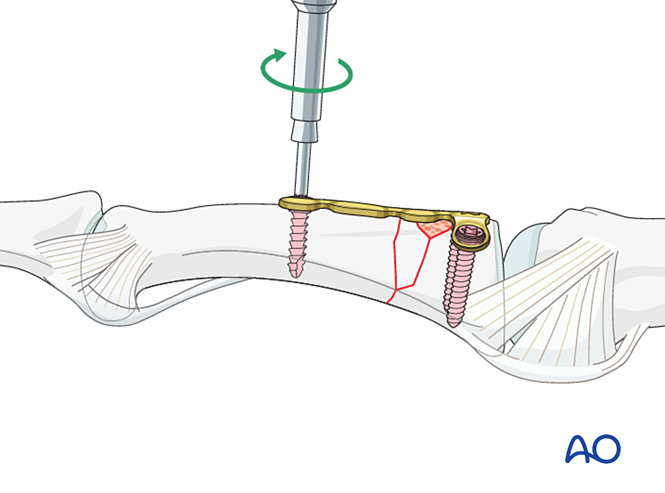 Plating with a dorsal T-plate for Complete articular fracture of the ...
