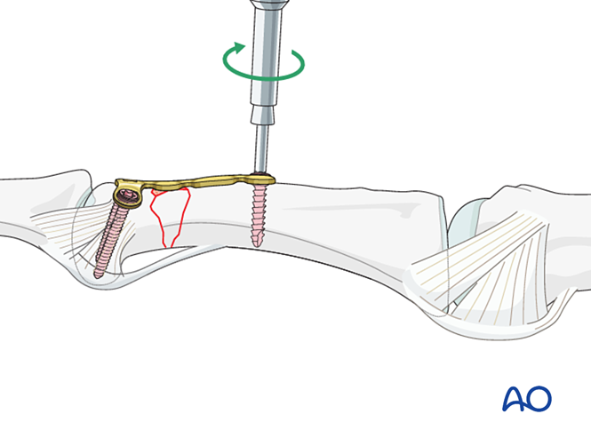 Plating with a dorsal T-plate for Complete articular fracture of the ...
