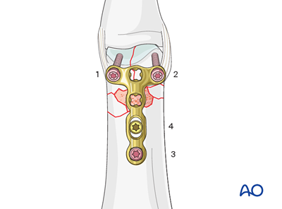 Plating with a dorsal T-plate for Complete articular fracture of the ...