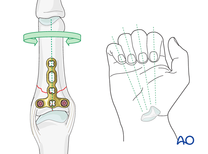 Plating with a dorsal T-plate for Complete articular fracture of the ...