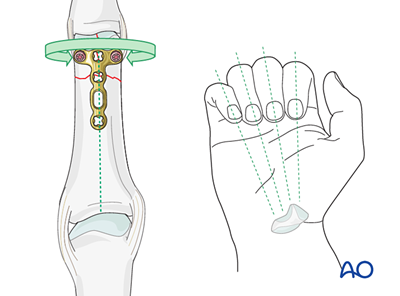 Plating with a dorsal T-plate for Complete articular fracture of the ...