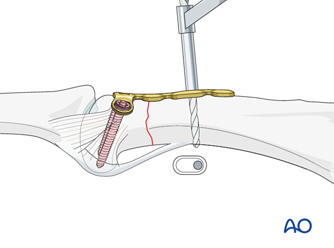 Plating with a dorsal T-plate for Complete articular fracture of the ...