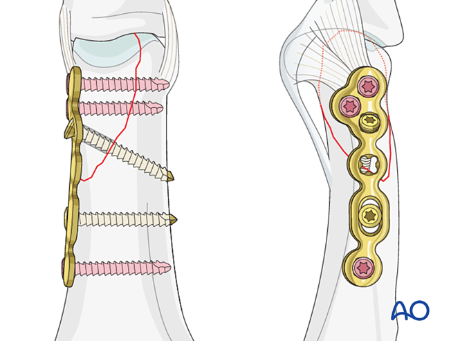 Lag-screw fixation with a neutralization plate for Partial articular ...