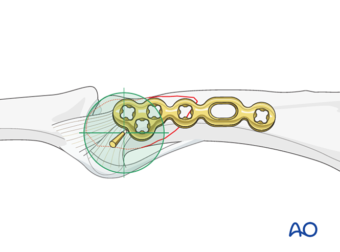 Lag-screw fixation with a neutralization plate for Partial articular ...