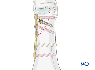 Lag-screw fixation with a neutralization plate for Partial articular ...