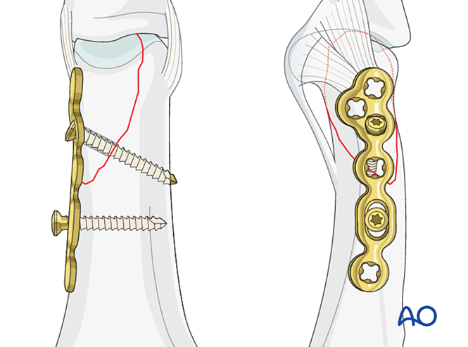 Lag-screw fixation with a neutralization plate for Partial articular ...