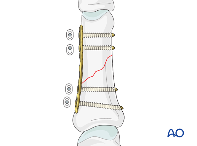 Compression plating for Oblique fracture of the diaphysis
