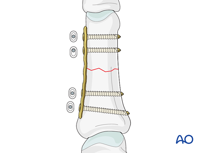 Compression plating for Transverse fracture of the diaphysis