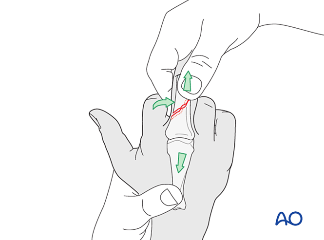 Compression plating for Oblique fracture of the diaphysis