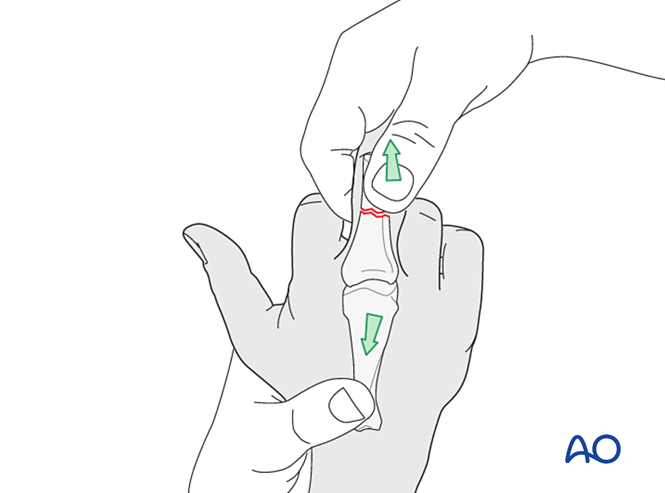 Compression plating for Transverse fracture of the diaphysis