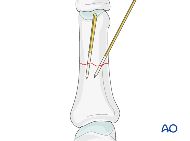 Compression plating for Transverse fracture of the diaphysis