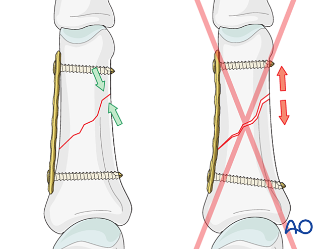 Compression plating for Oblique fracture of the diaphysis