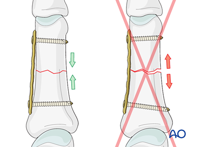 Compression plating for Transverse fracture of the diaphysis