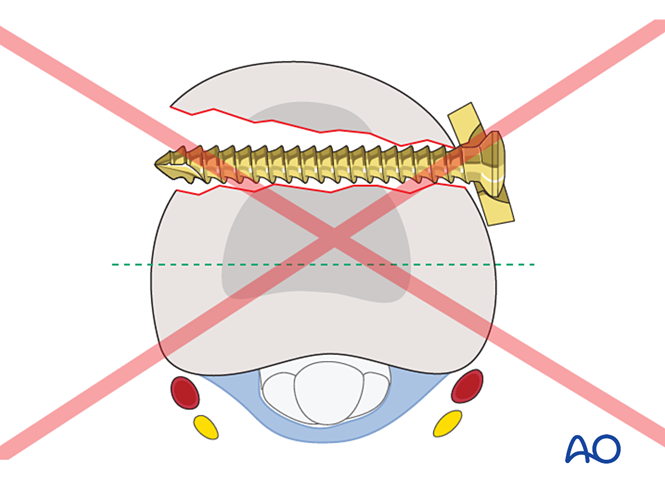 Compression plating for Oblique fracture of the diaphysis