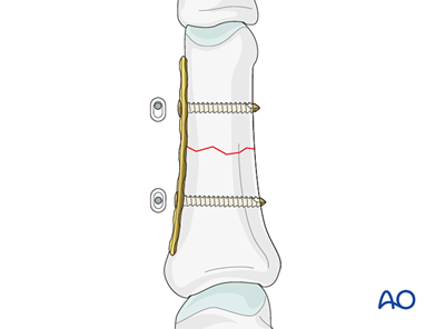 Compression plating for Transverse fracture of the diaphysis