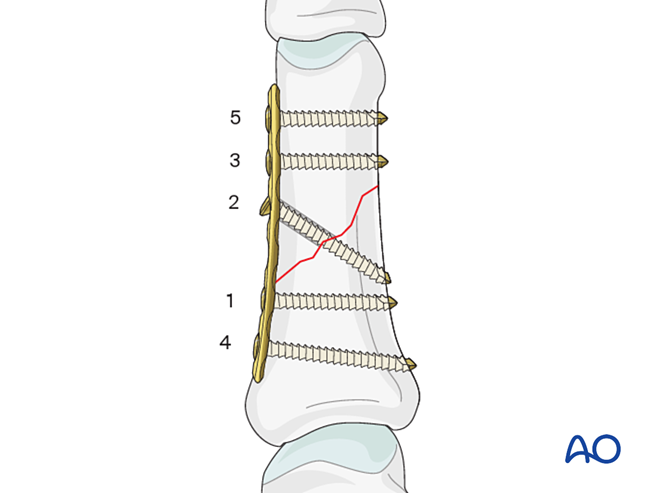Compression plating for Oblique fracture of the diaphysis