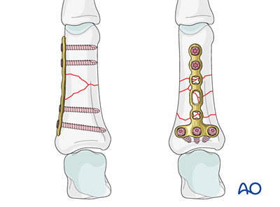 Bridge plating for Wedge/multifragmentary fracture of the diaphysis