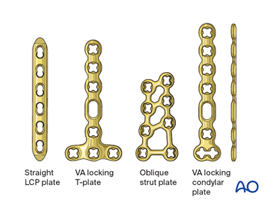 Bridge plating for Wedge/multifragmentary fracture of the diaphysis