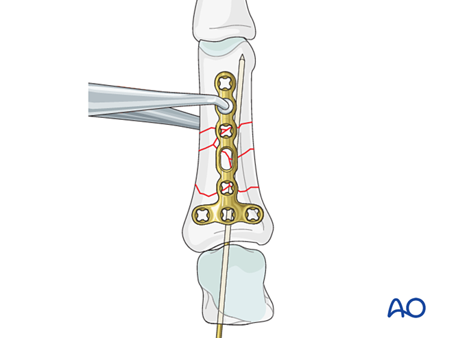 Bridge plating for Wedge/multifragmentary fracture of the diaphysis
