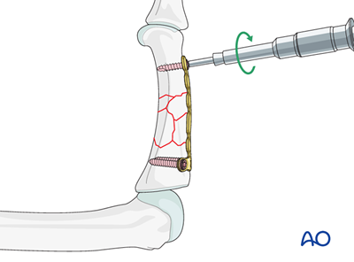 Bridge plating for Wedge/multifragmentary fracture of the diaphysis