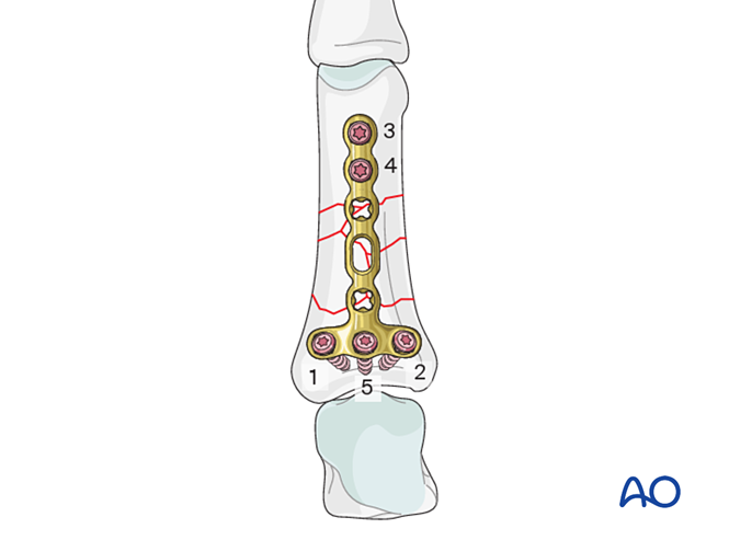 Bridge plating for Wedge/multifragmentary fracture of the diaphysis