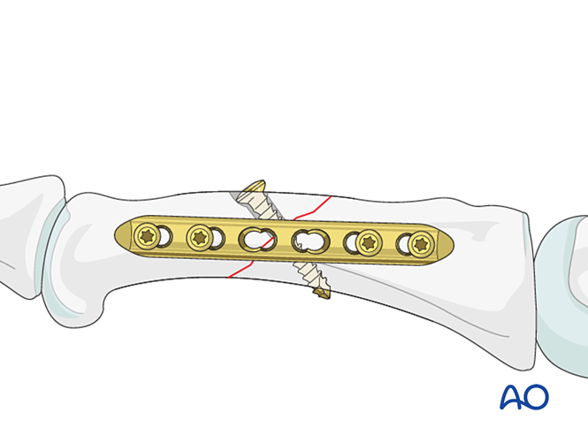 Lag-screw fixation with a neutralization plate for Oblique fracture of ...