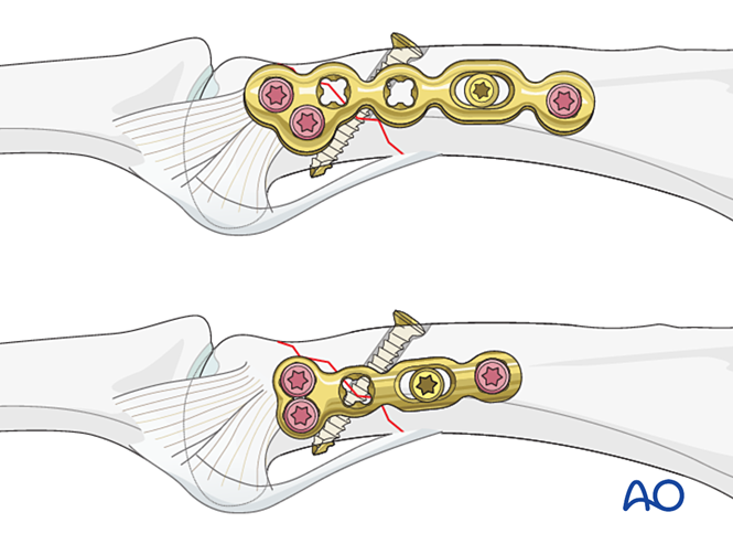 Lag-screw fixation with a neutralization plate for Oblique ...