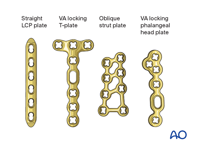 Lag-screw fixation with a neutralization plate for Partial articular ...