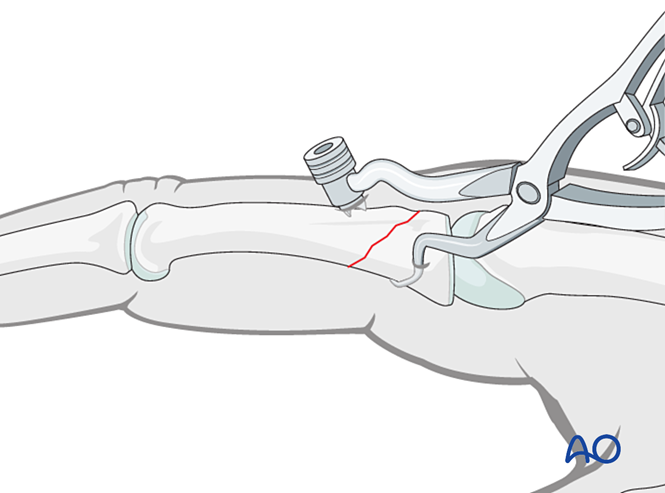 Lag-screw fixation with a neutralization plate for Oblique ...