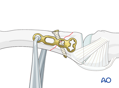 Lag-screw fixation with a neutralization plate for Oblique ...