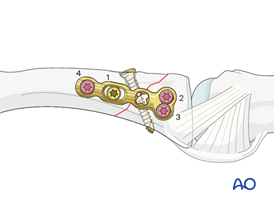 Lag-screw fixation with a neutralization plate for Oblique ...