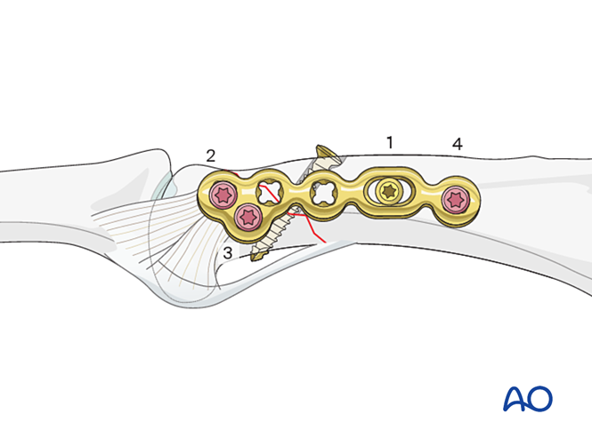 Lag-screw fixation with a neutralization plate for Oblique ...