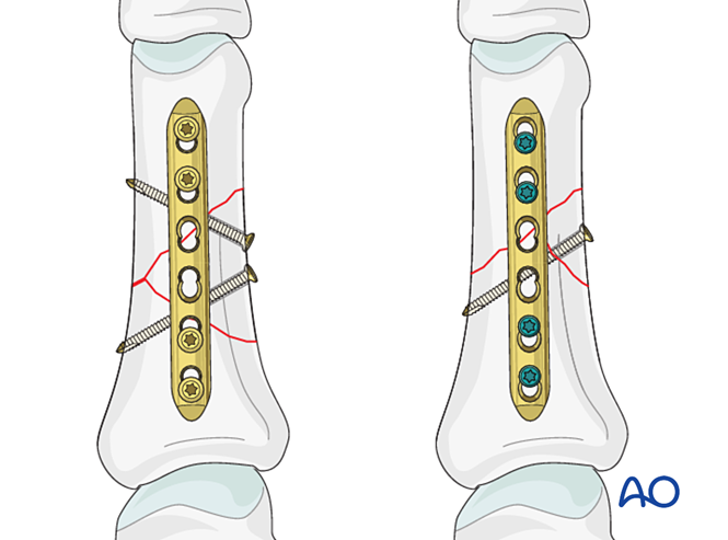 Lag-screw and plate fixation for Wedge/multifragmentary fracture of the ...