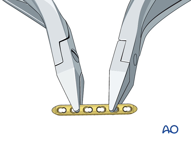 Lag-screw and plate fixation for Wedge/multifragmentary fracture of the ...