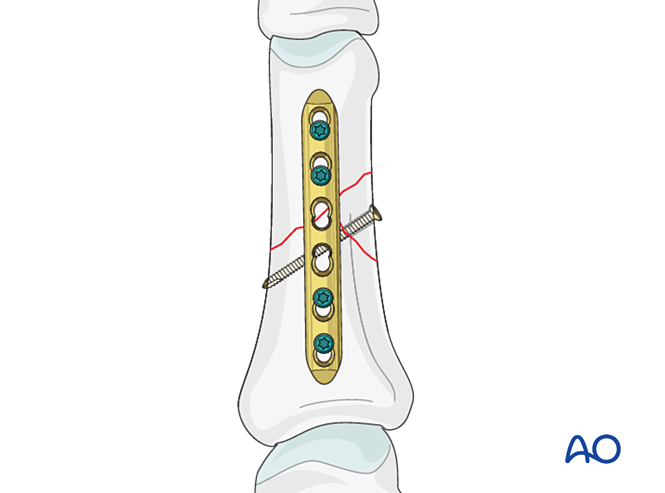 Lag-screw and plate fixation for Wedge/multifragmentary fracture of the ...
