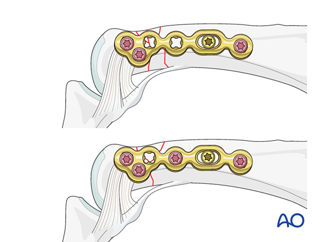 Bridge plating for Wedge/multifragmentary extraarticular fracture of ...