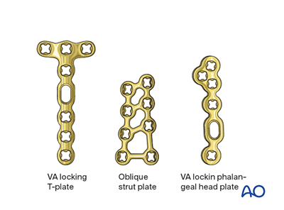 Bridge plating for Wedge/multifragmentary extraarticular fracture of ...